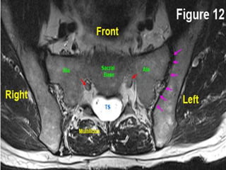 ANATOMY OF MRI SPINE | PPTX