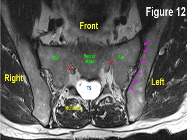ANATOMY OF MRI SPINE | PPTX