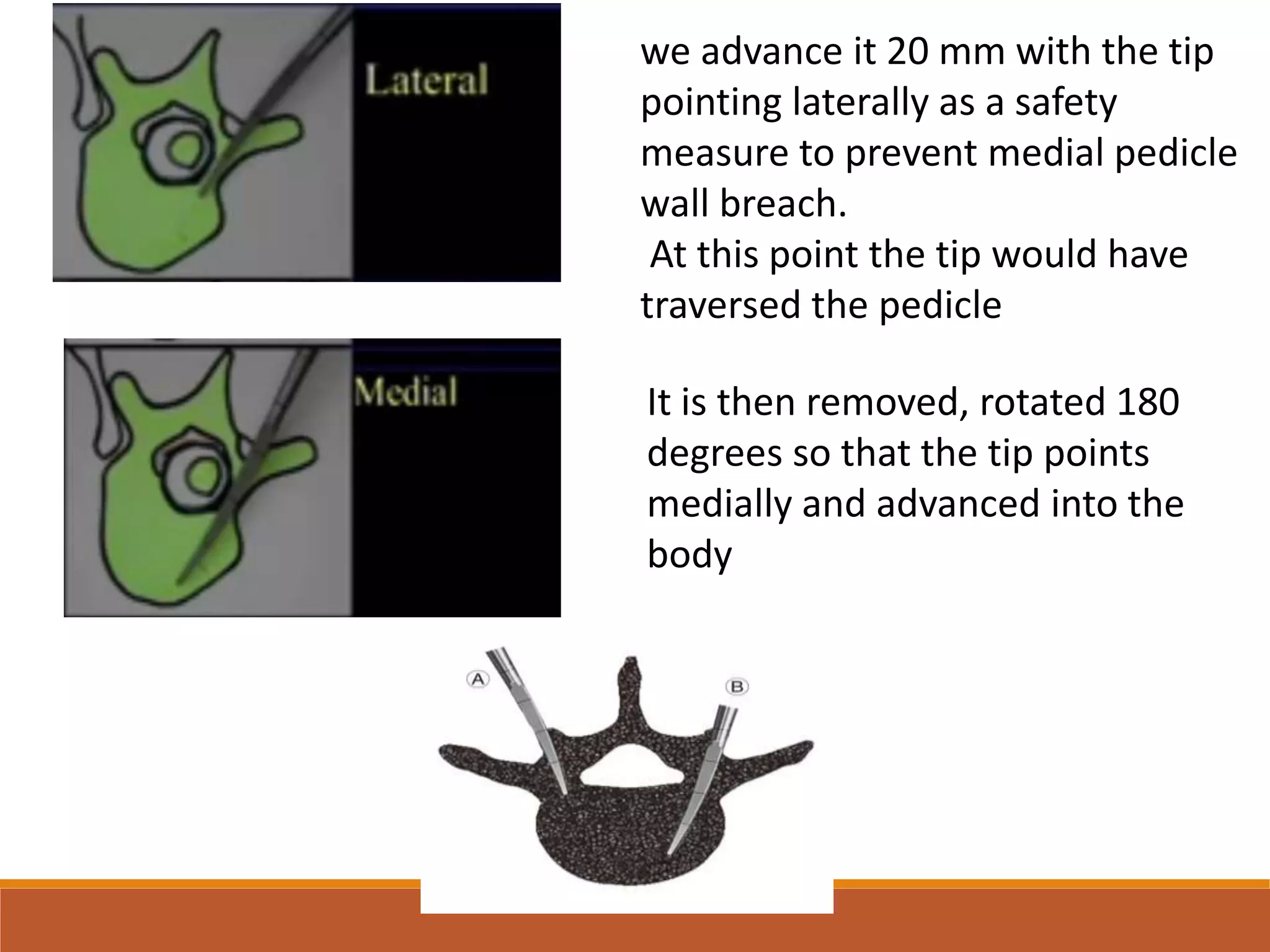 pedicle screw insertion | PPTX