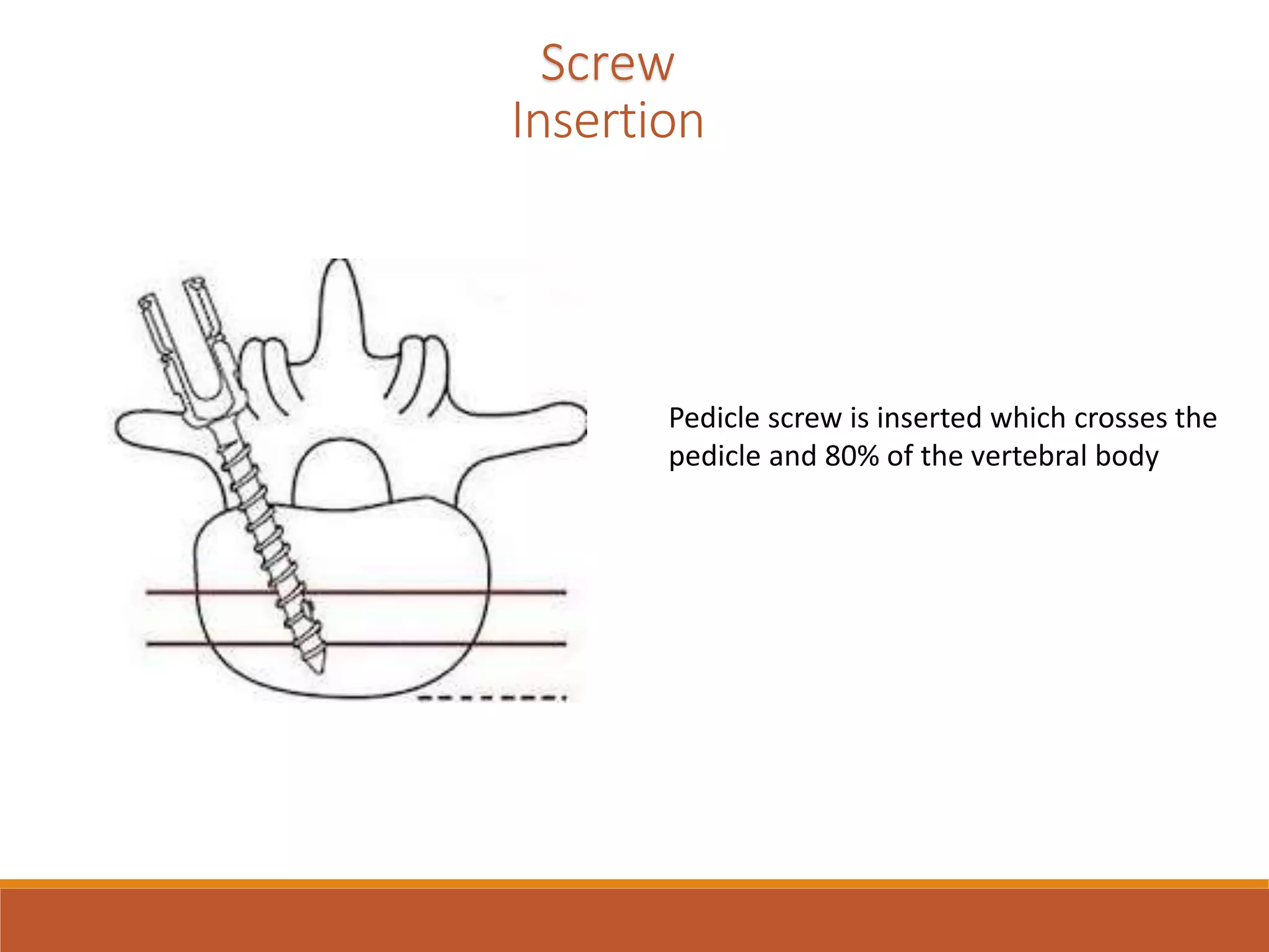 pedicle screw insertion | PPTX
