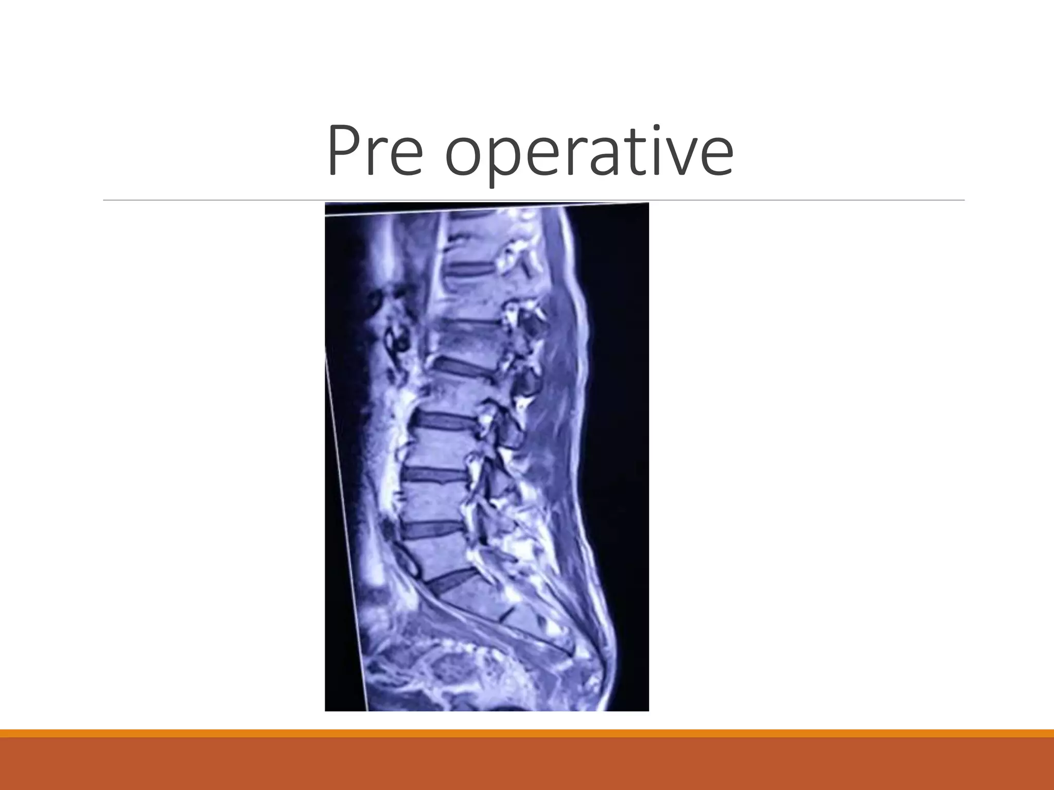 pedicle screw insertion | PPTX