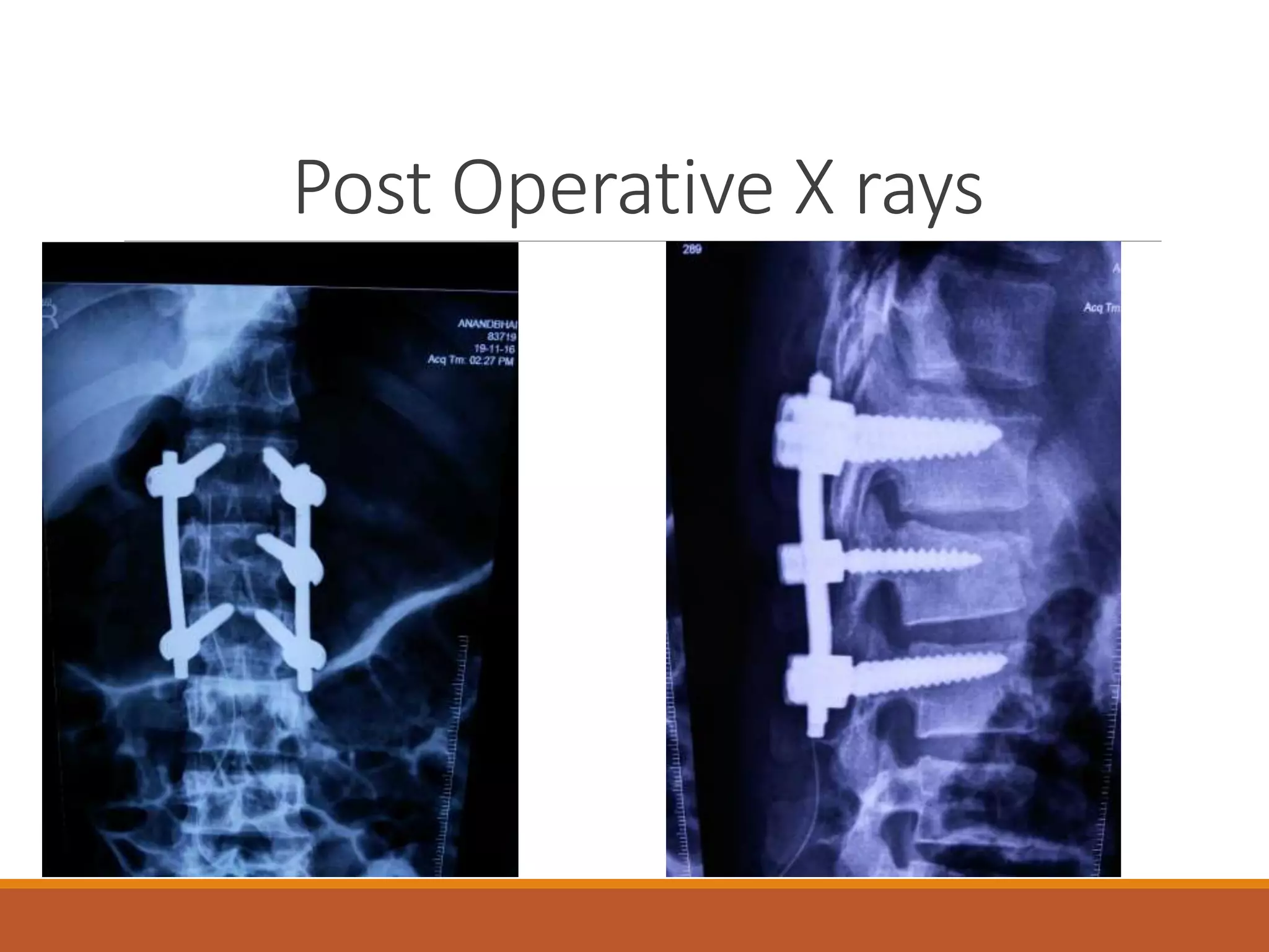 pedicle screw insertion | PPTX