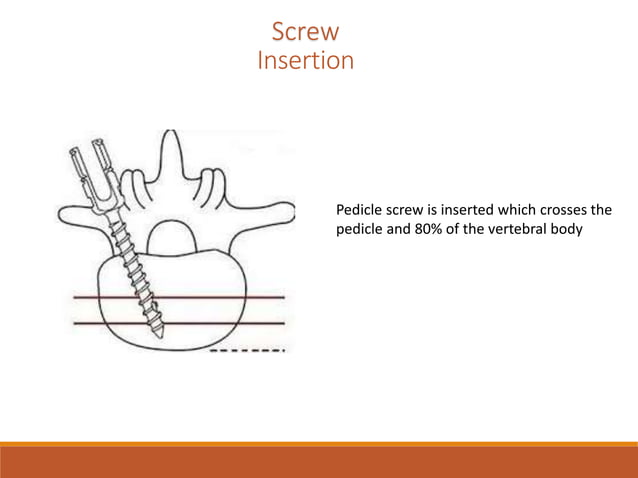 pedicle screw insertion | PPTX