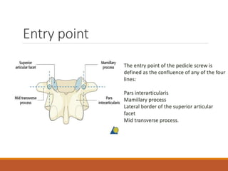 pedicle screw insertion | PPTX