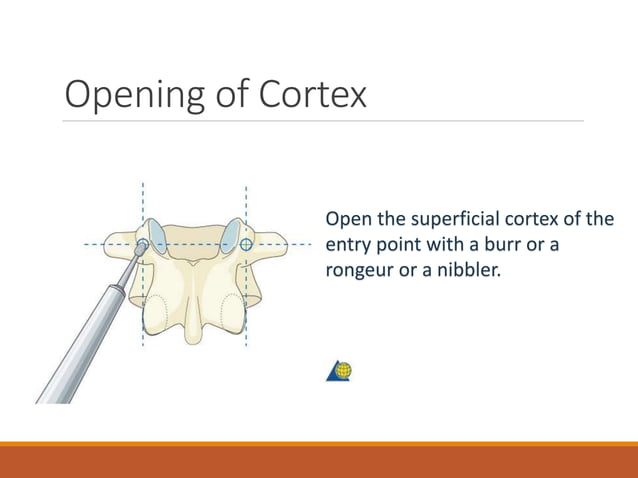pedicle screw insertion | PPTX