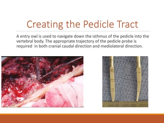 pedicle screw insertion | PPTX