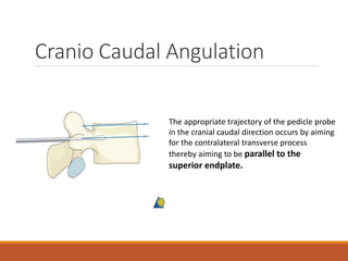 pedicle screw insertion | PPTX