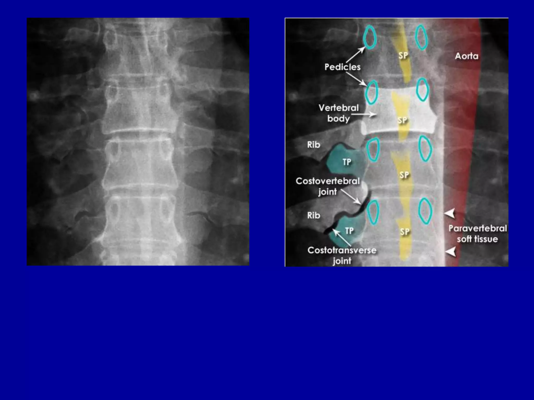 Spine radiography | PPTX