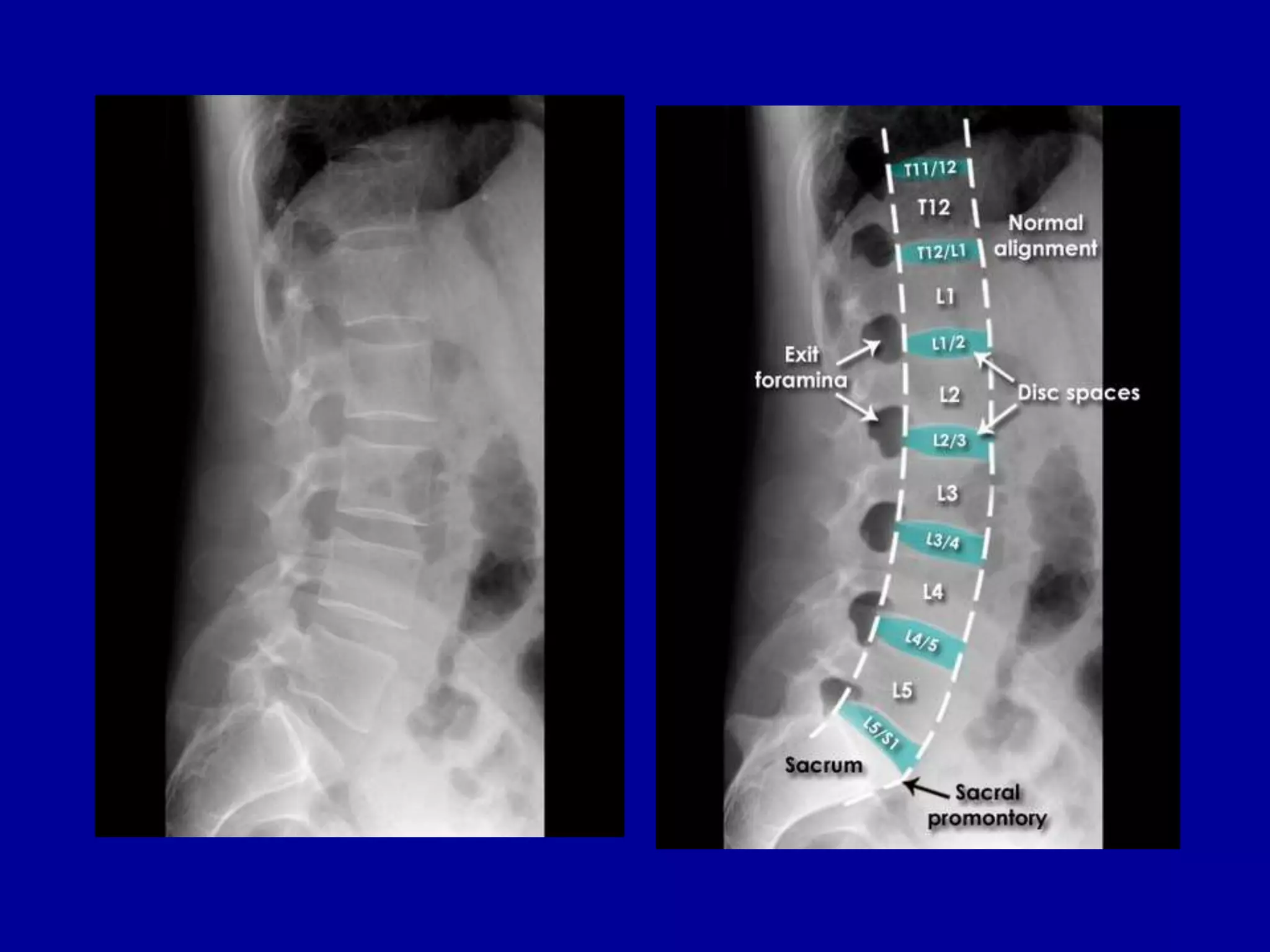 Spine radiography | PPTX