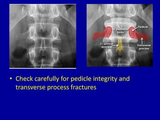 Transverse Process Fracture X Ray