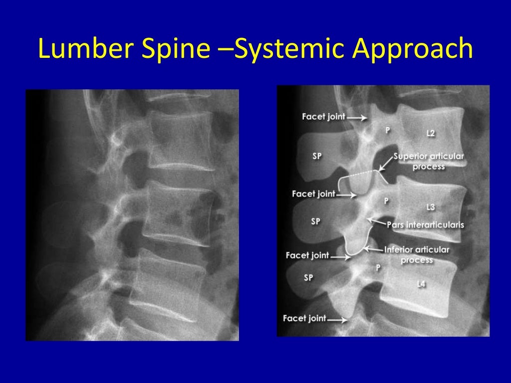 Spine radiography