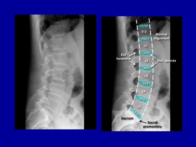 Spine_Radiography.pptx