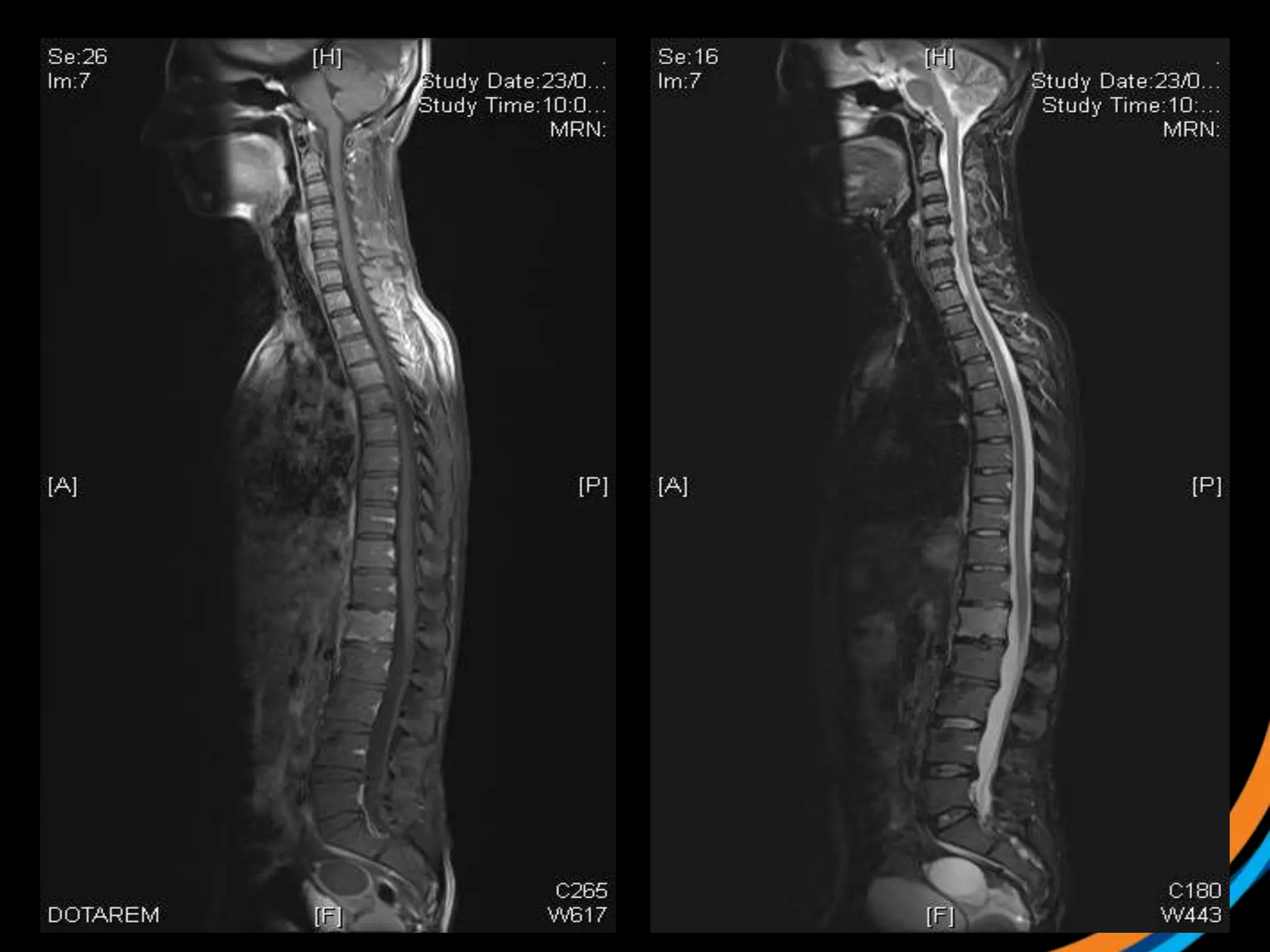Spine Sbrt For Beginners Pptx