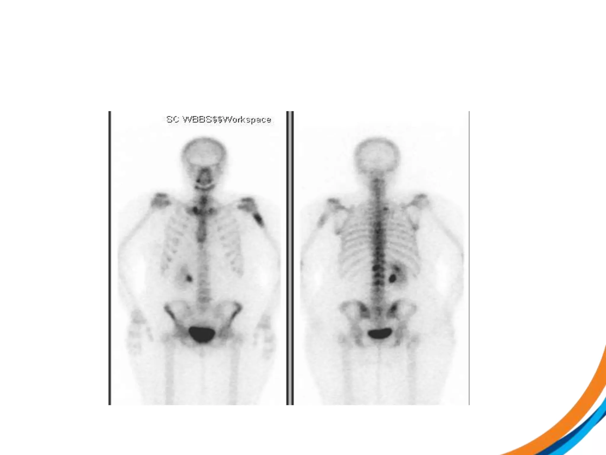 SPINE SBRT for beginners | PPTX