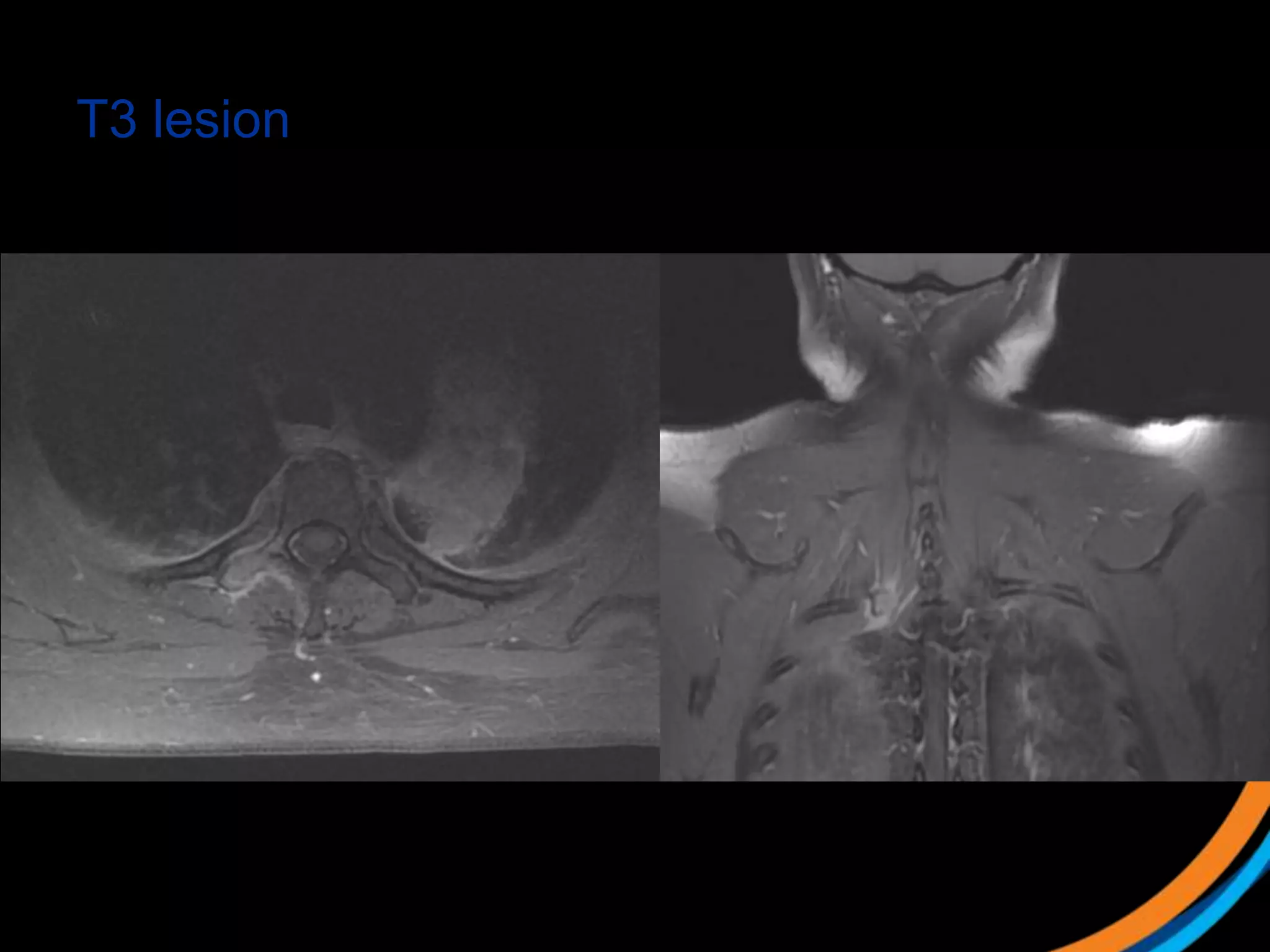 SPINE SBRT for beginners | PPTX