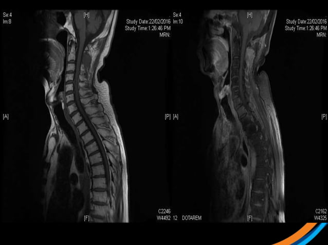 SPINE SBRT for beginners | PPTX