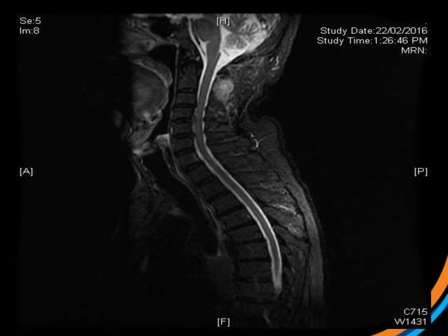 SPINE SBRT for beginners | PPTX