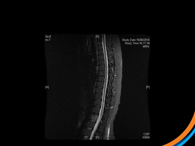 SPINE SBRT for beginners | PPTX