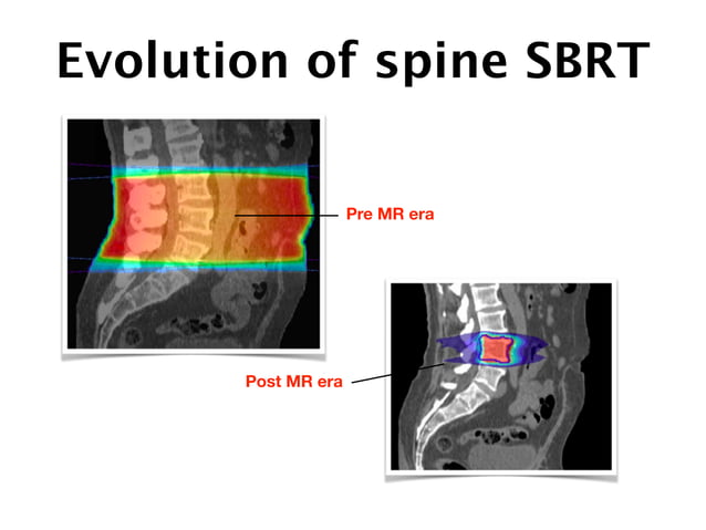 Spine SBRT toxicities & Management | PPT