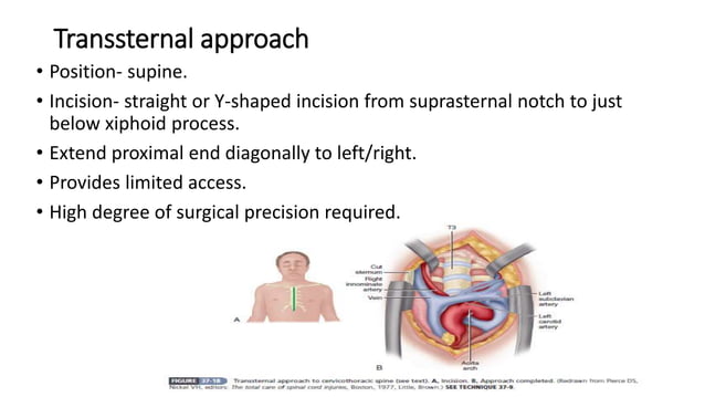 Surgical approaches to spine | PPTX