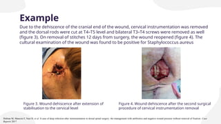 Spine Surgical Site Infection-1.pptx scrubbing | PPTX