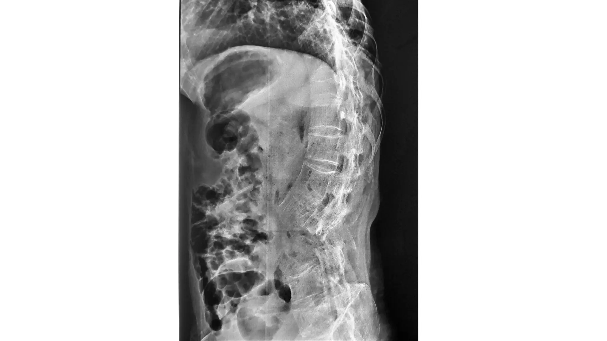 Spine trauma in kyphotic osteoporosis pt | PPT