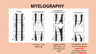 Comprehensive Approach to Diagnosis and Management of Spinal Tumours | PPTX