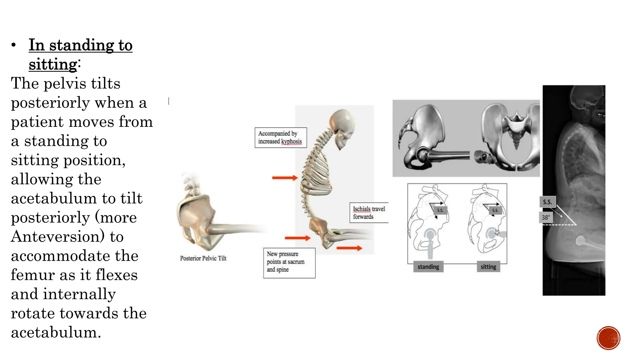 Spino-pelvic relation to total hip replacment.pptx