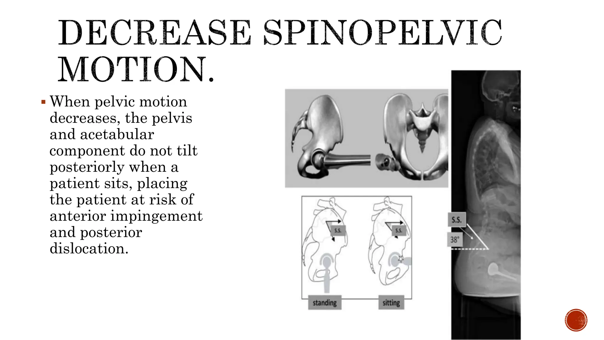Spino-pelvic relation to total hip replacment.pptx