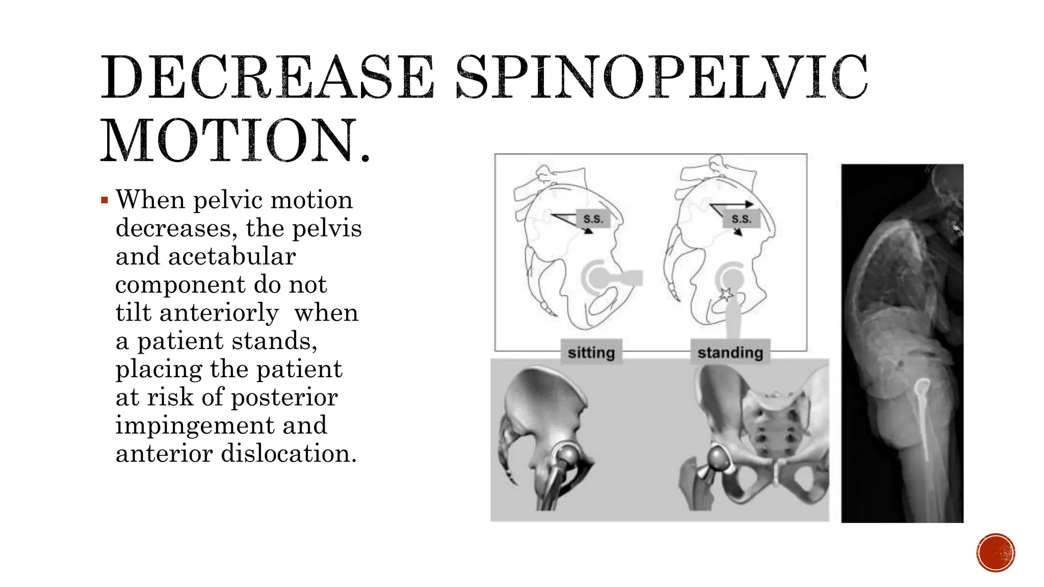 Spino-pelvic relation to total hip replacment.pptx