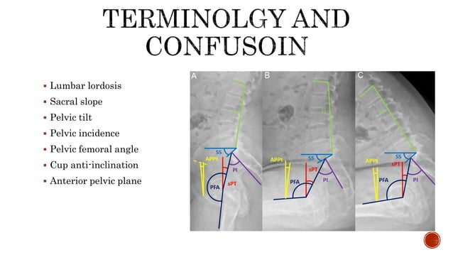 Spino-pelvic relation to total hip replacment.pptx