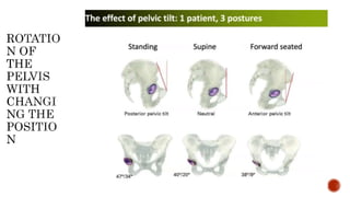 Spino-pelvic relation to total hip replacment.pptx
