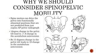 Spino-pelvic relation to total hip replacment.pptx