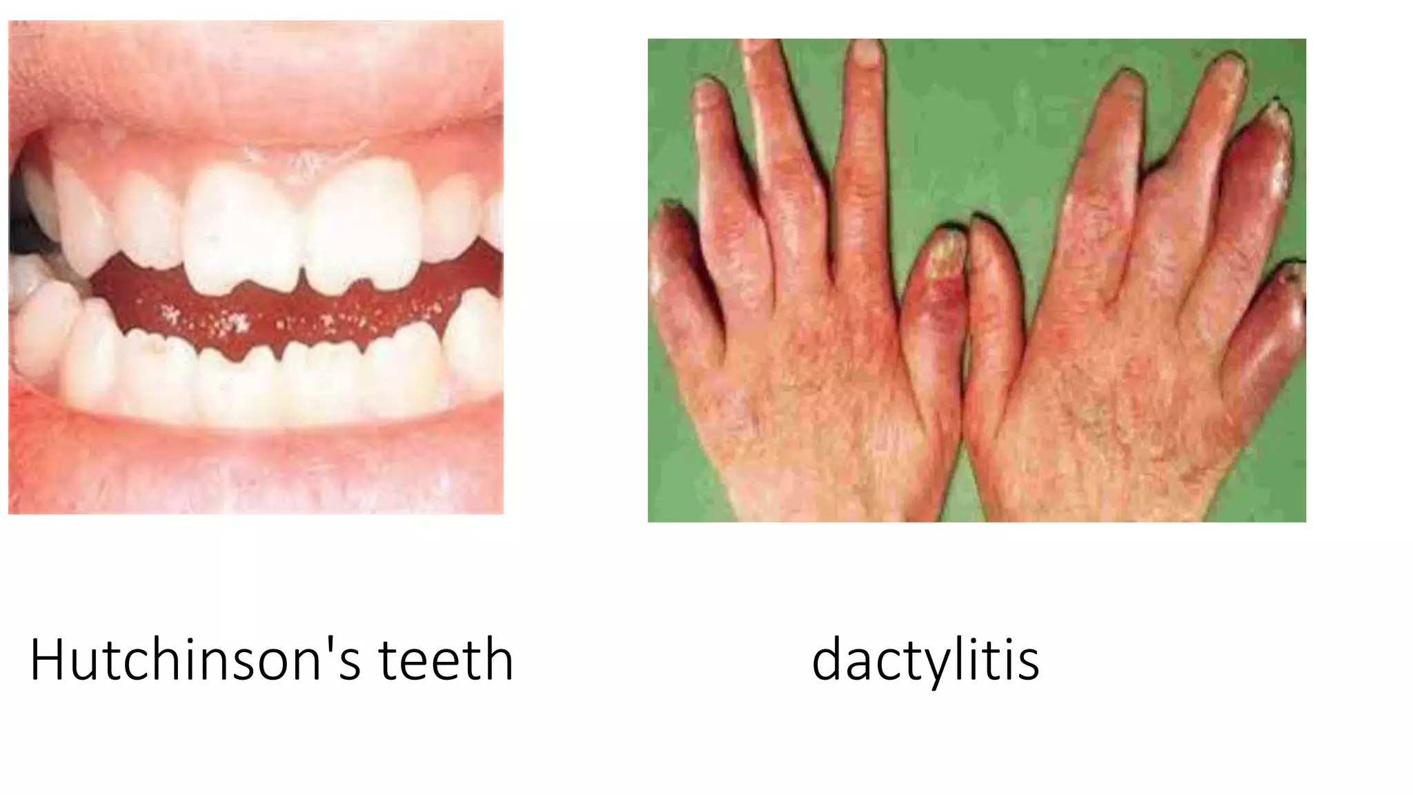 SPIROCHAETAL INFECTION in orthopaedics.pptx