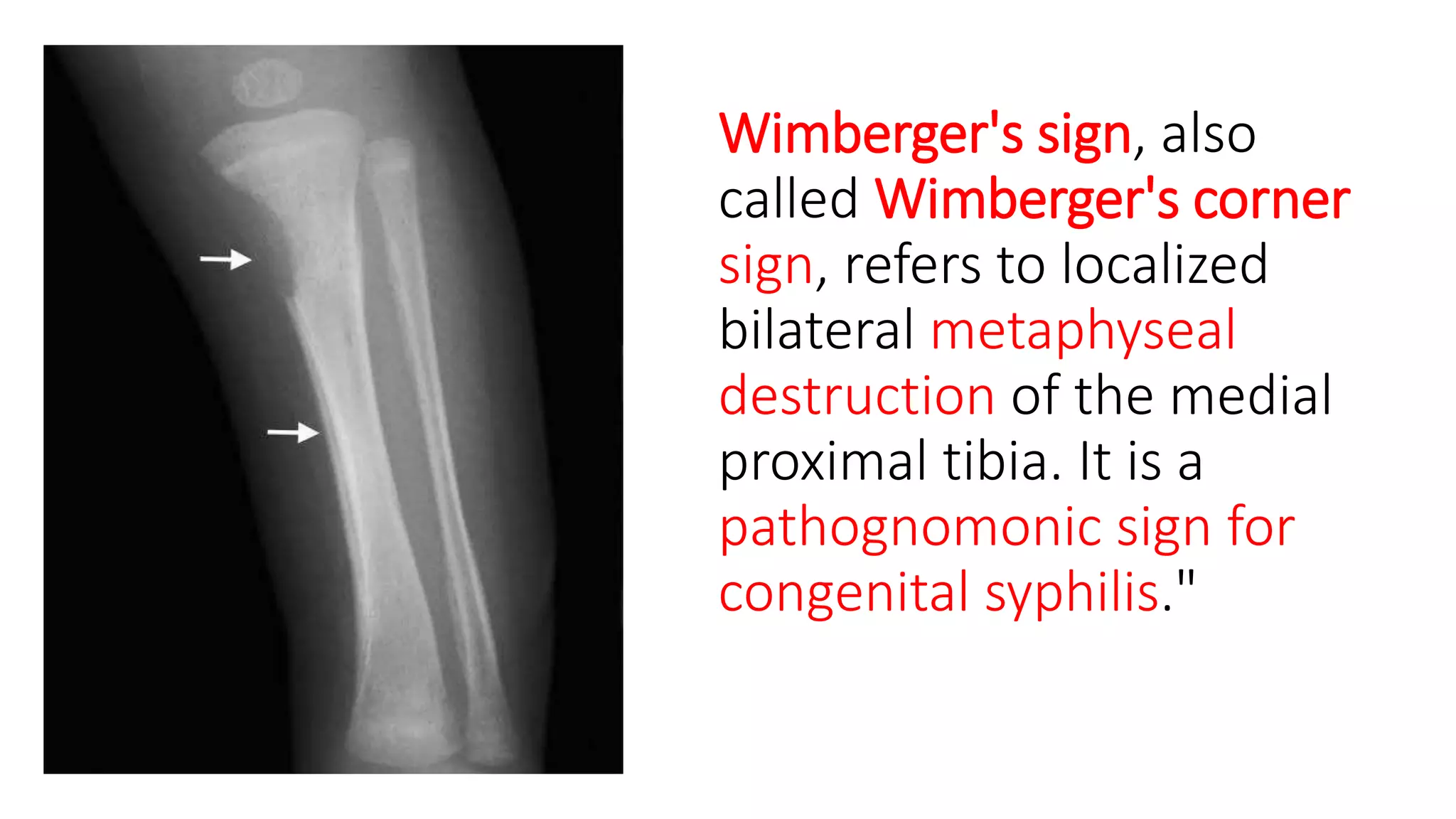 SPIROCHAETAL INFECTION in orthopaedics.pptx