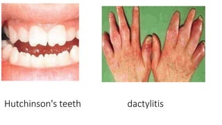 SPIROCHAETAL INFECTION in orthopaedics.pptx