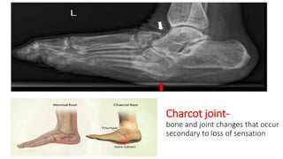 SPIROCHAETAL INFECTION in orthopaedics.pptx