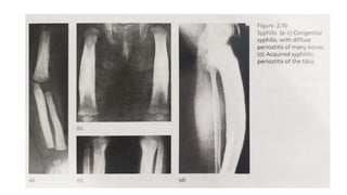 SPIROCHAETAL INFECTION in orthopaedics.pptx