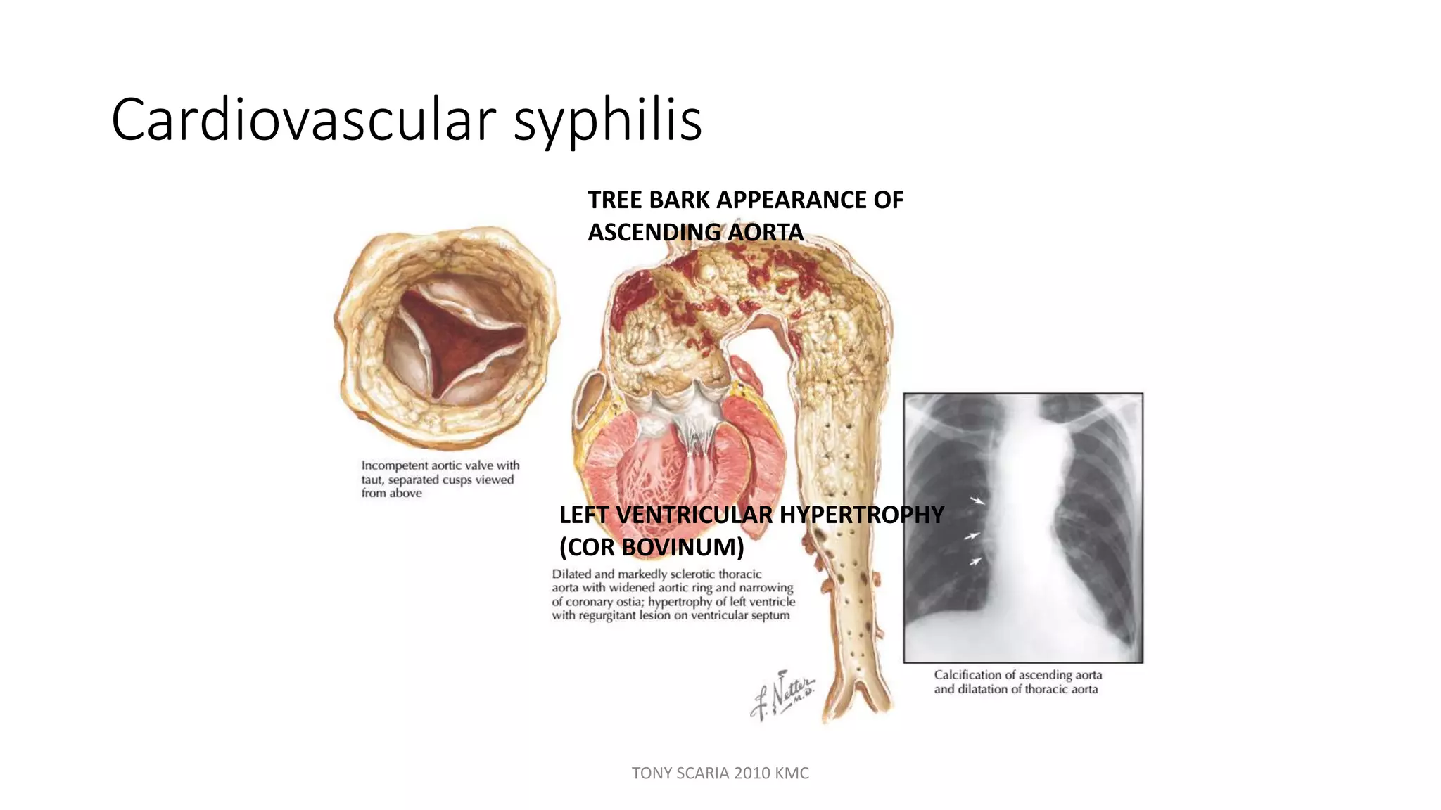 SPIROCHAETE REVISION NOTES MICROBIOLOGY | PDF