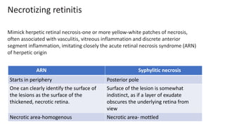 Spirocheteal uveitis | PPTX