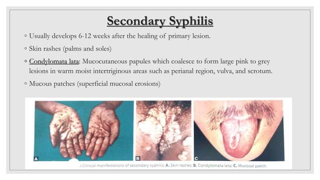 Spirochetes | PPTX | Infectious Diseases | Diseases and Conditions
