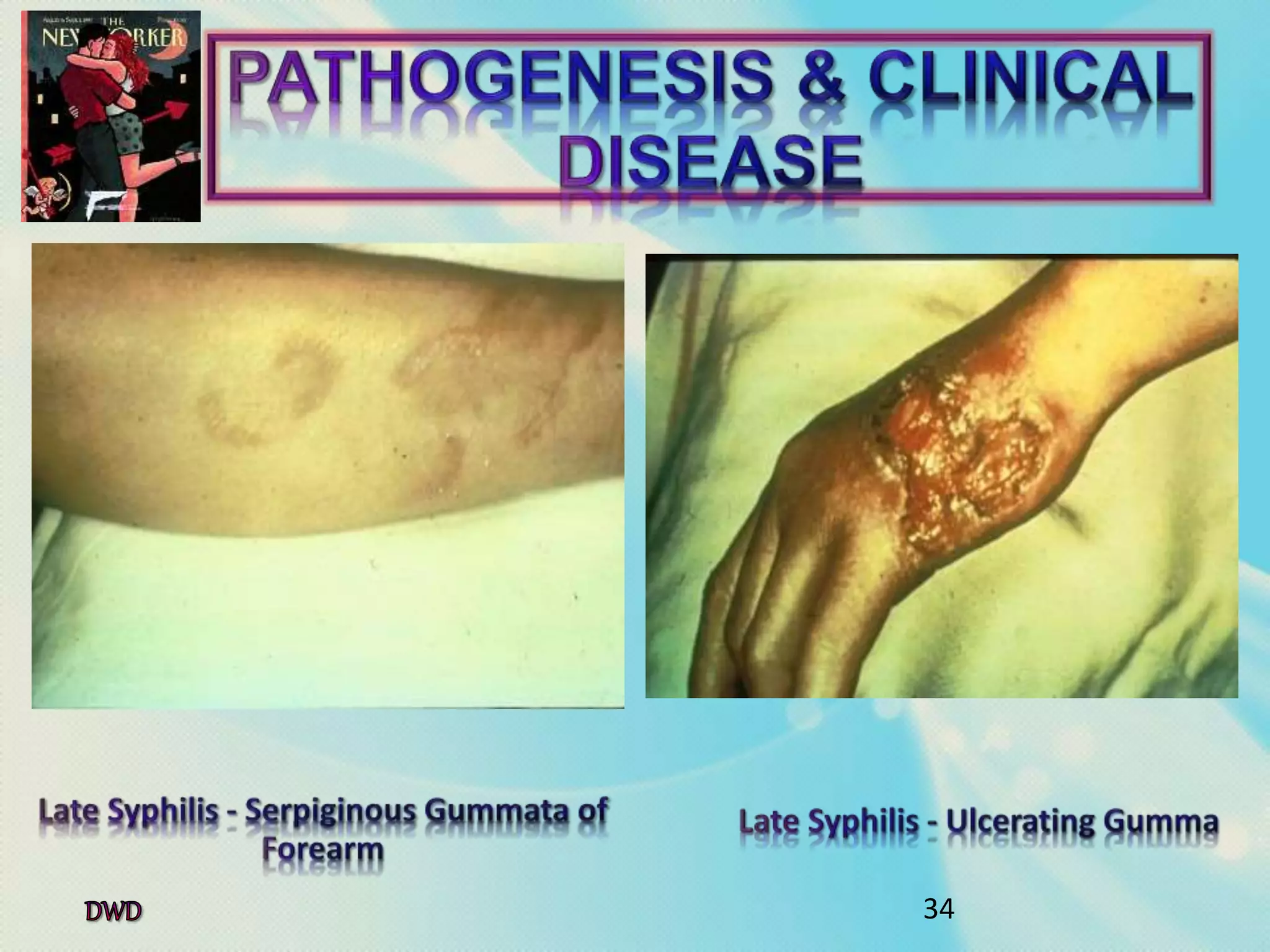 Spirochetes (treponema pallidum 1) | PPTX