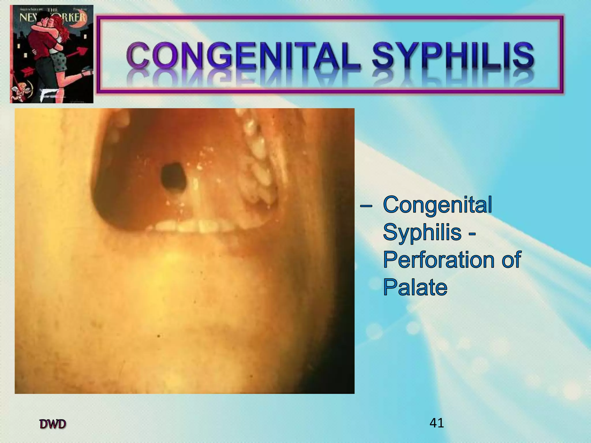 Spirochetes (treponema pallidum 1) | PPTX