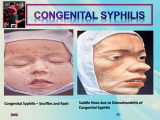 Congenital Syphilis Saddle Nose