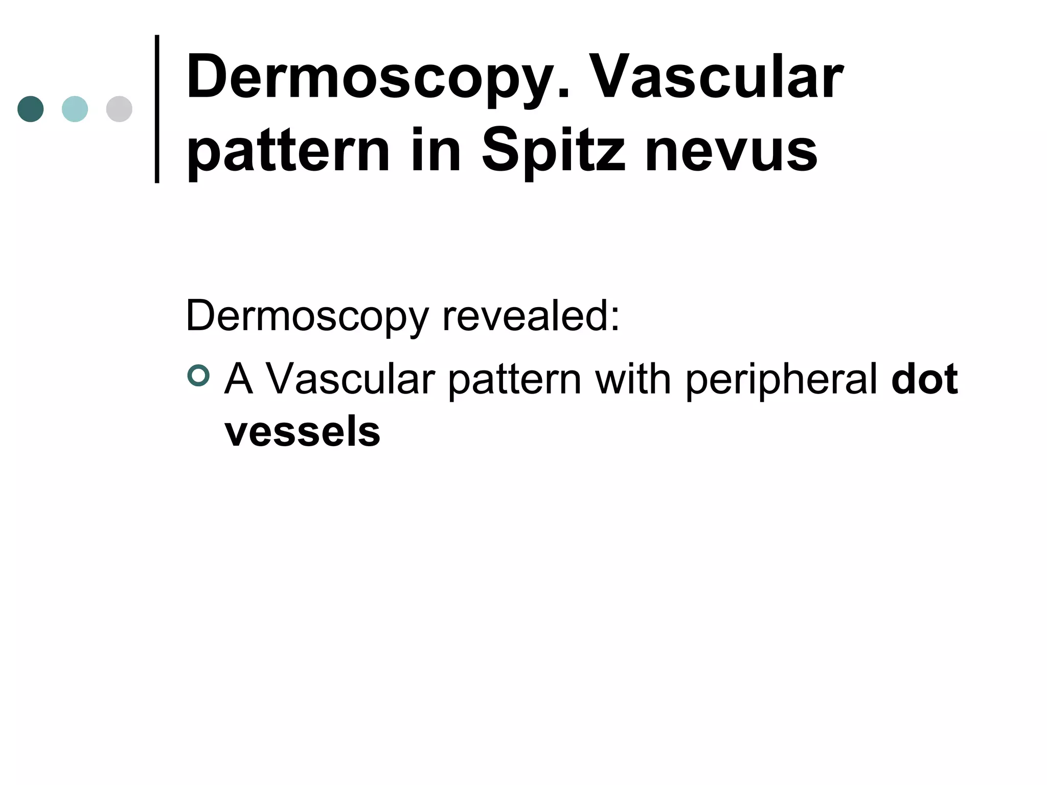 Spitz nevus | PPT
