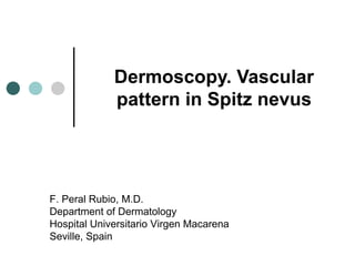 Spitz nevus | PPT