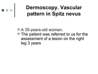 Spitz nevus | PPT