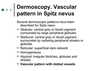 Spitz nevus | PPT