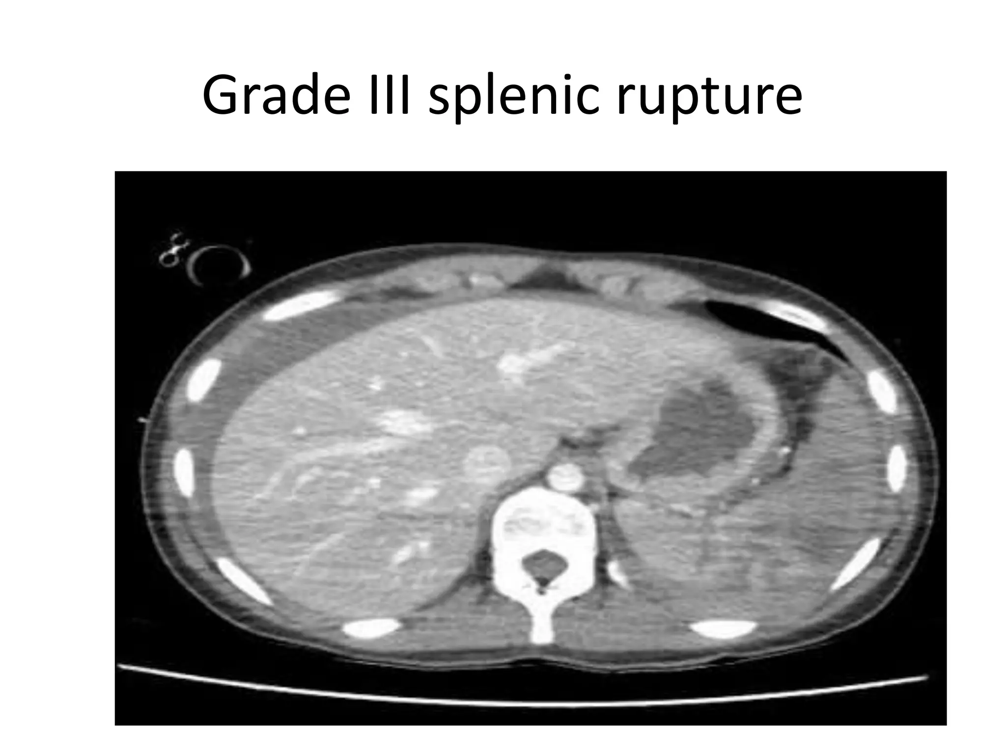 Spleen Radiology | PPTX