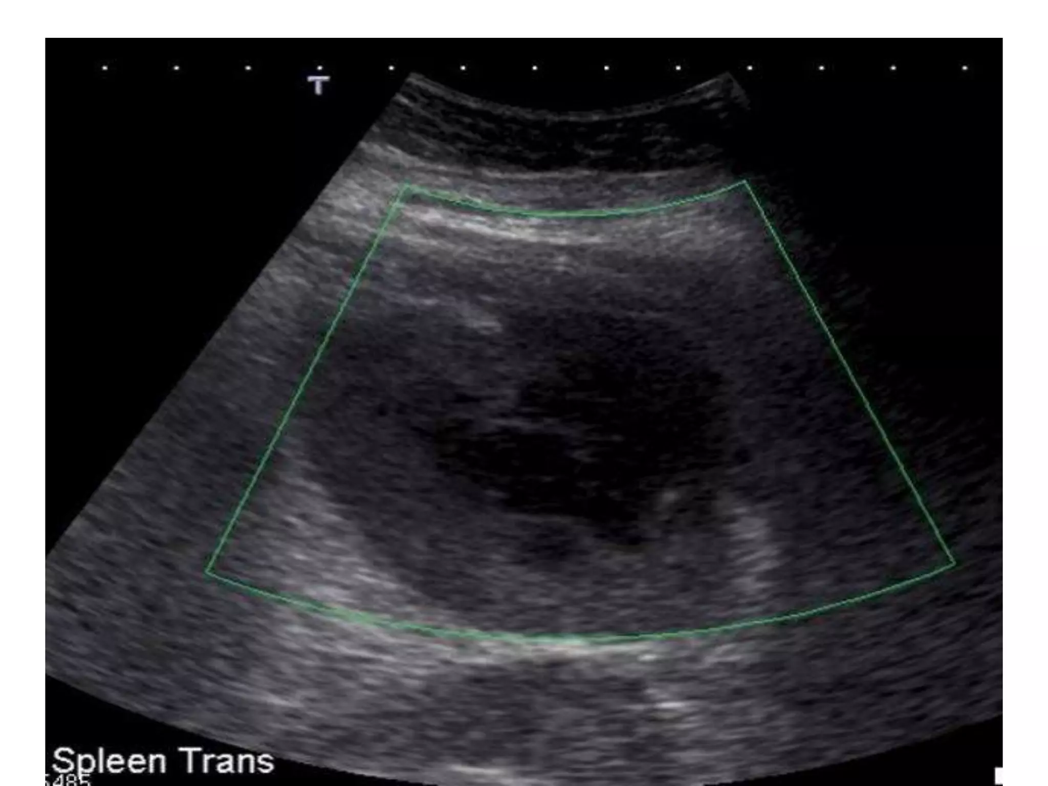 Spleen Radiology | PPTX